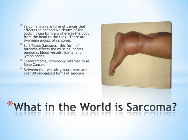 Sarcoma | PPTX