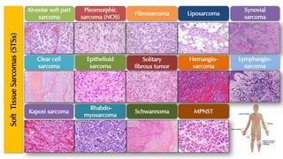 Sarcoma | PDF | Cancer | Diseases and Conditions