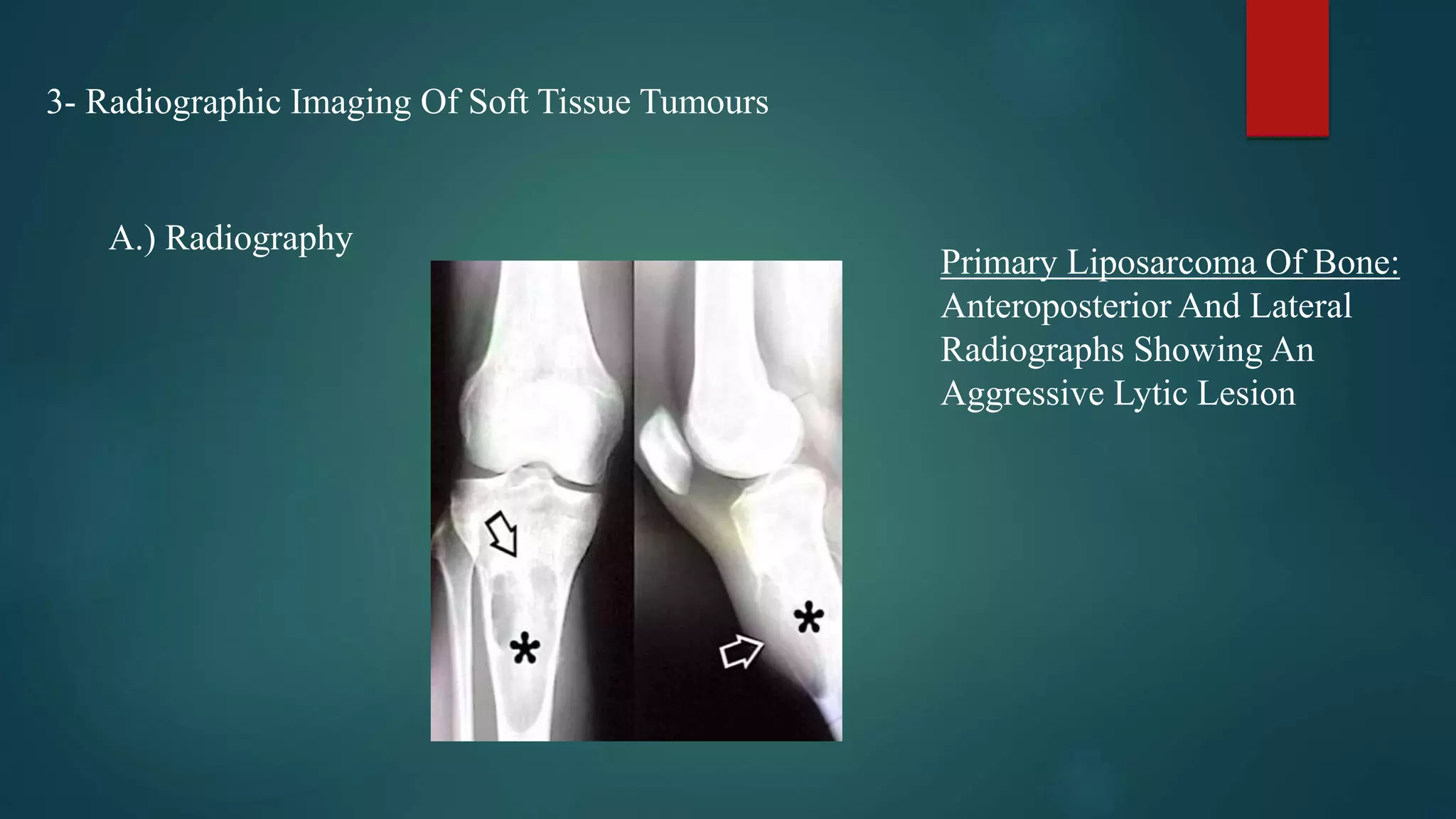 Sarcoma Pptx