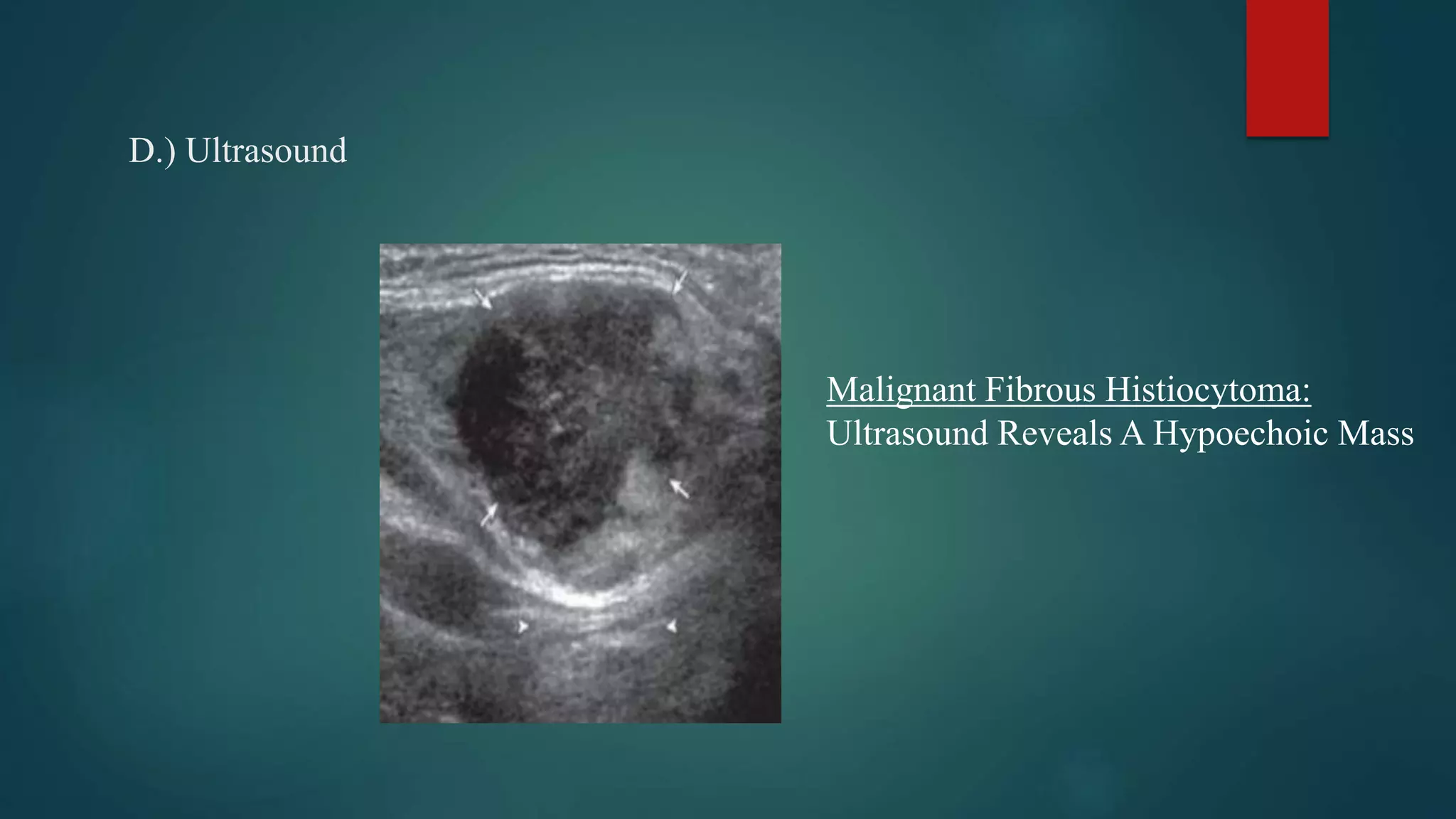 Sarcoma | PPTX