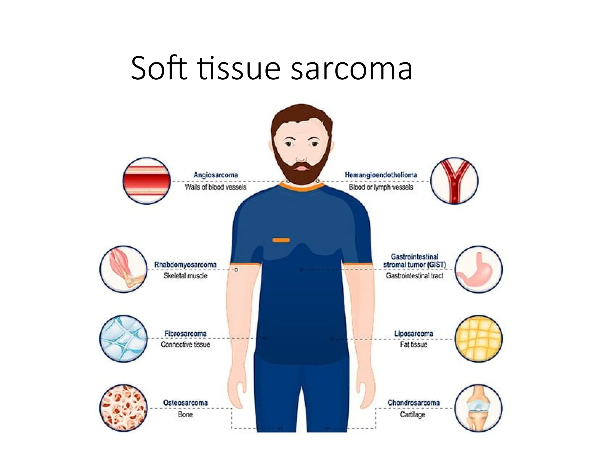 SARCOMA types and categories path. Docu | PPTX