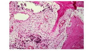 Sarcoma de Ewing | PPTX