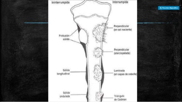 Sarcoma de Ewing