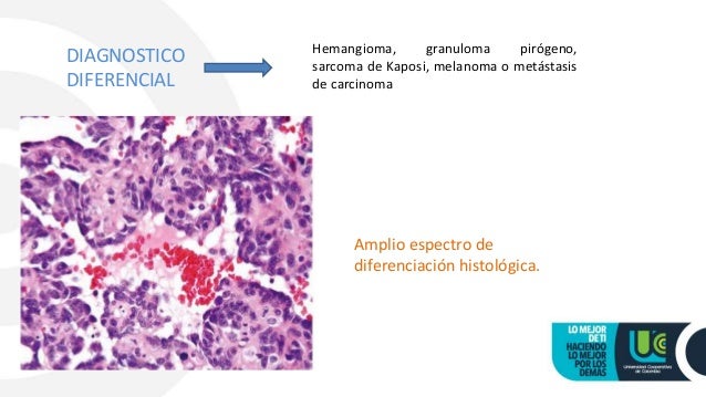 Sarcoma de kaposi
