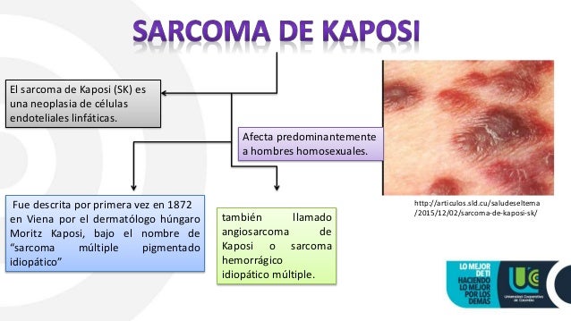 Sarcoma de kaposi