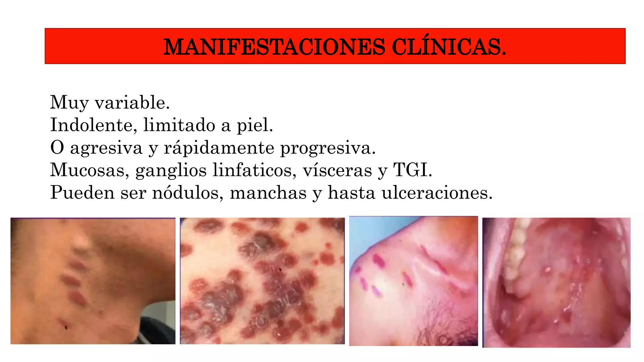 Sarcoma de Kaposi.pptx