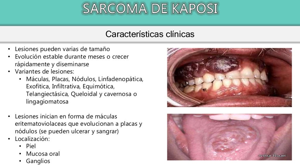 Sarcoma de Kaposi