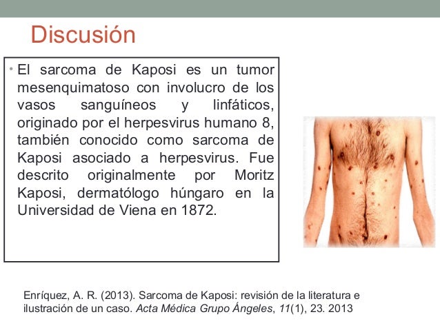 Sarcoma de kaposi