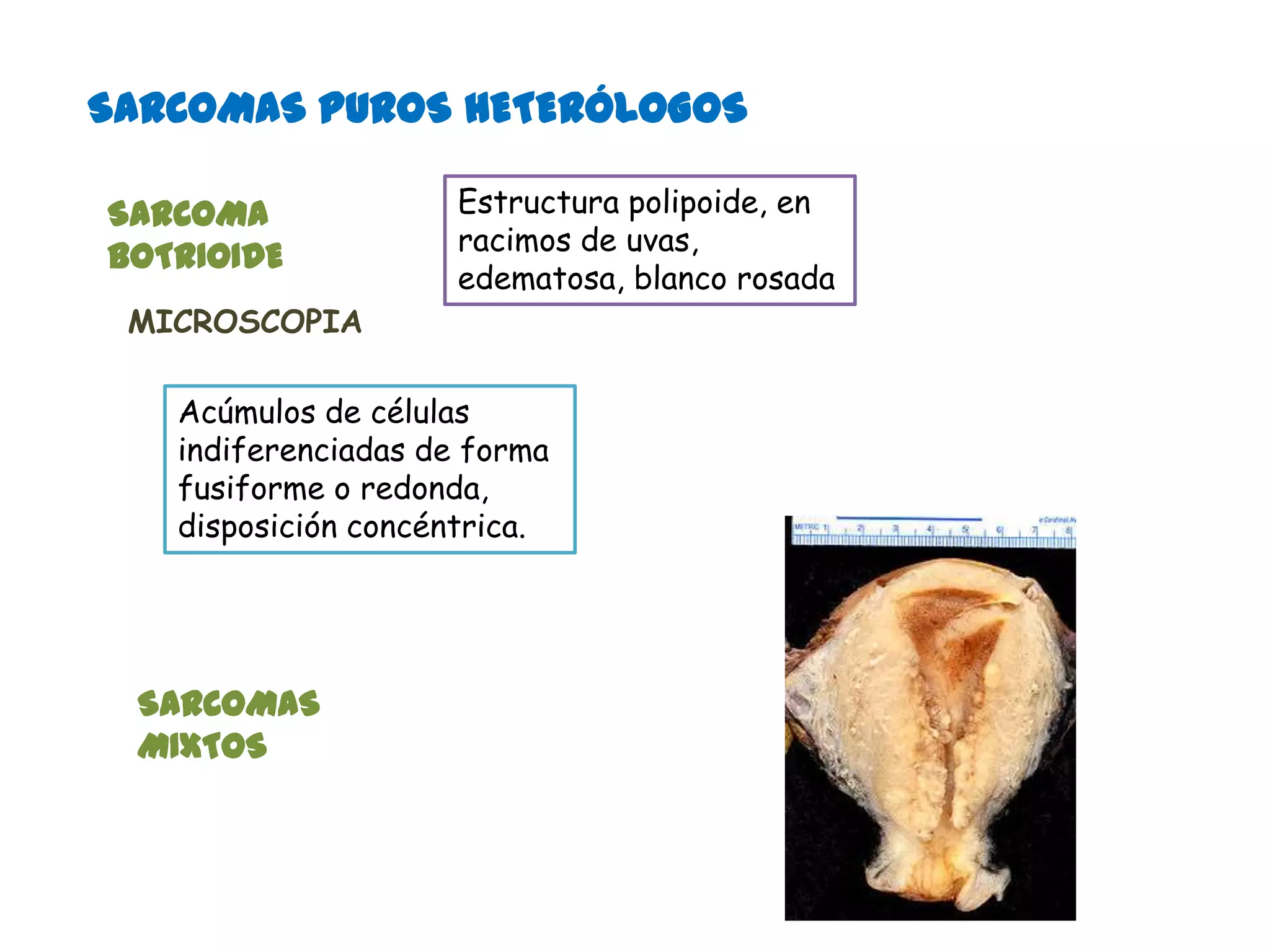 Sarcomas uterinos | PPTX