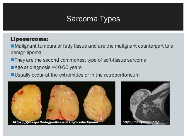 Sarcoma - Mussa Mensa
