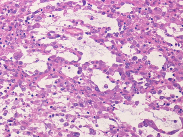 Sarcomatoid carcinoma. myxoid and sclerosing | PPT