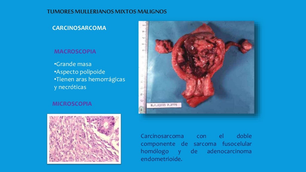 Sarcoma uterino