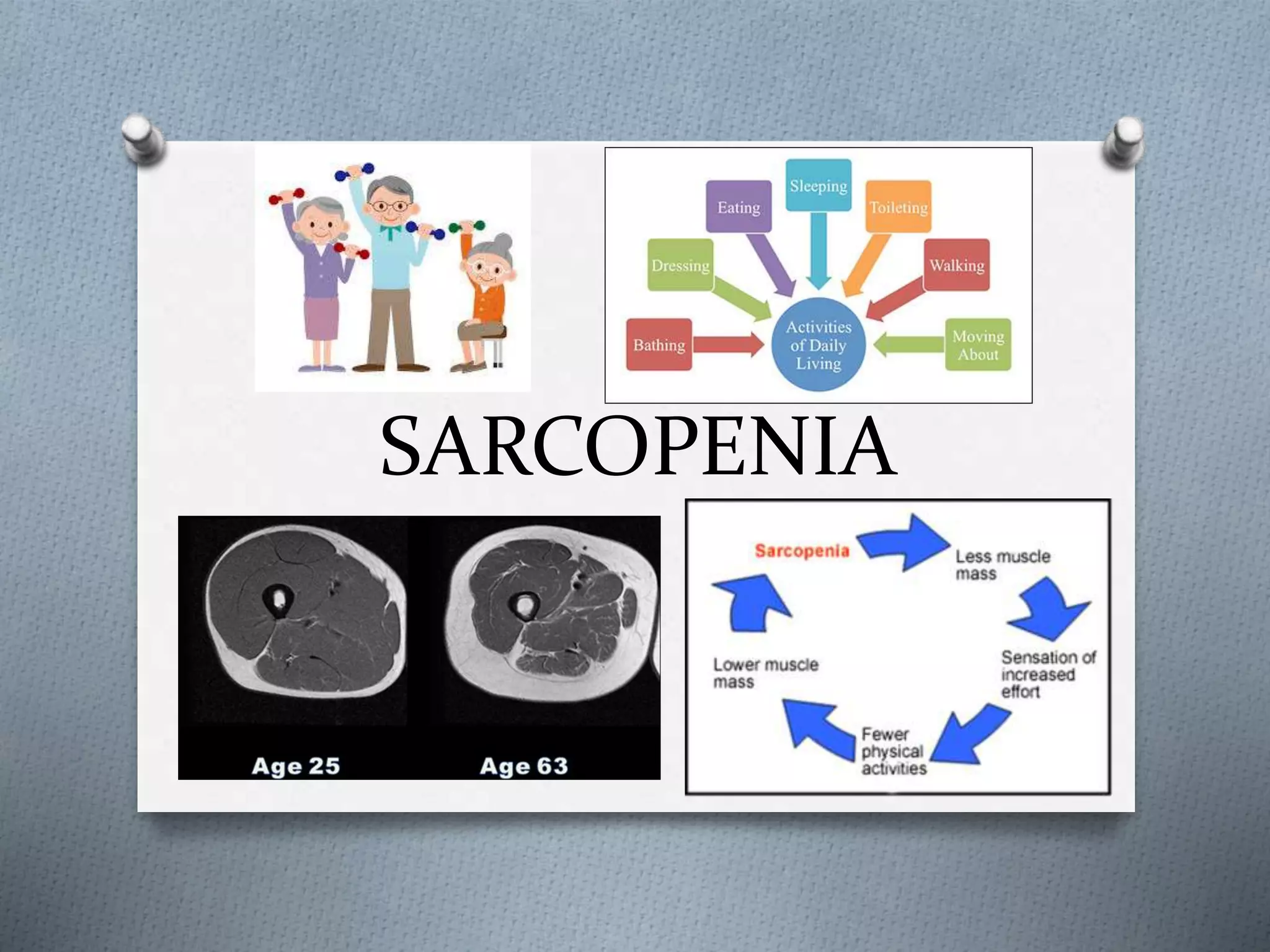 Sarcopenia - identifying, measuring and managing muscle loss in elderly ...