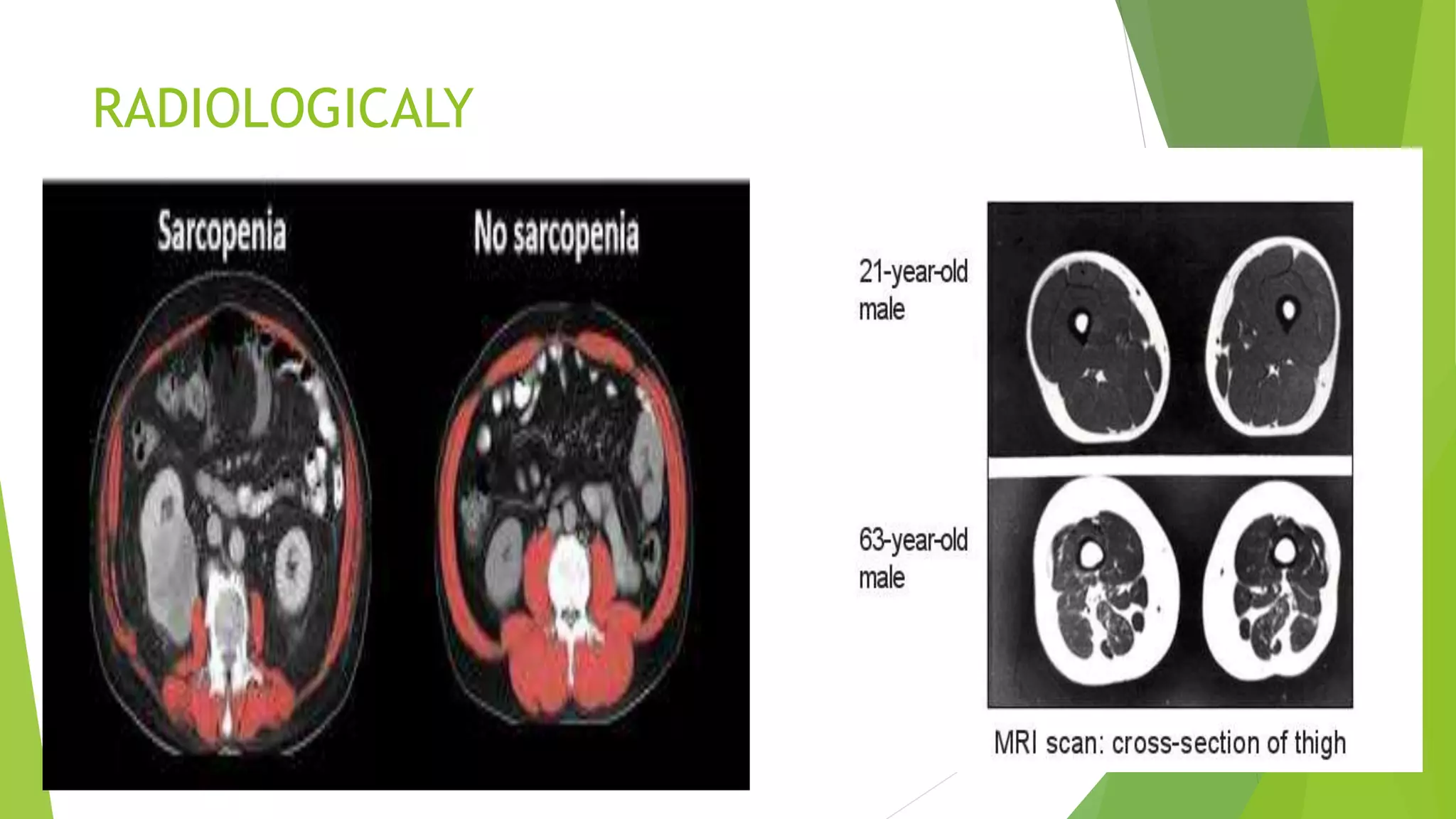 Sarcopenia in surgery.dr quiyum | PPTX | Endocrine and Metabolic ...