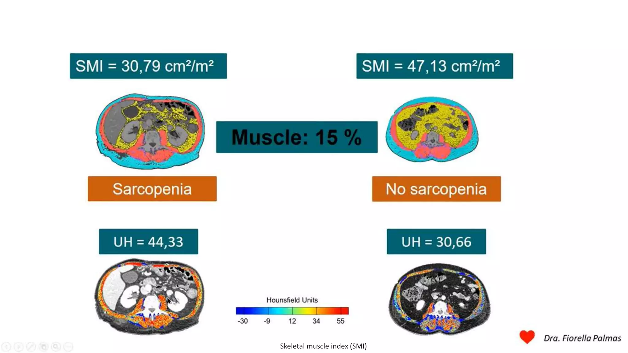 Sarcopenic Obesity.pptx