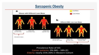 Sarcopenic Obesity.pptx