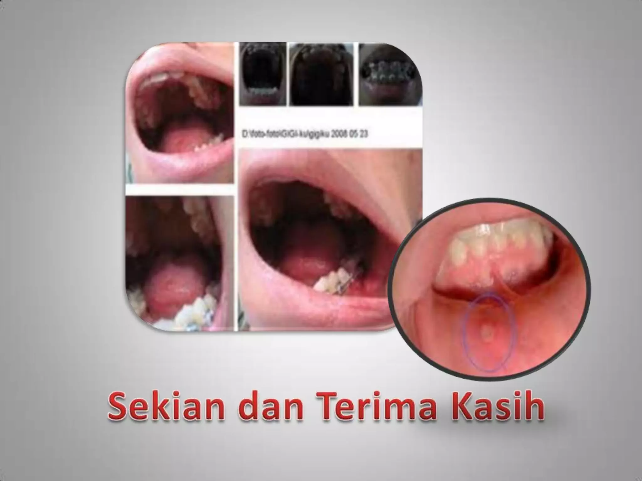 Sariawaaaaaan(stomatitis) | PPTX