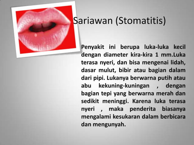 Sariawaaaaaan(stomatitis) | PPTX