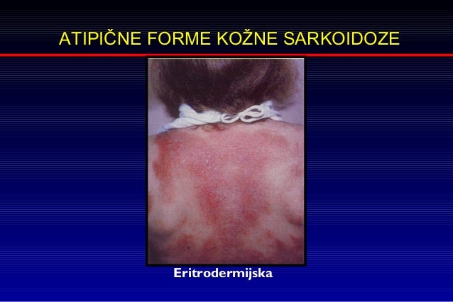 Sarkoidoza