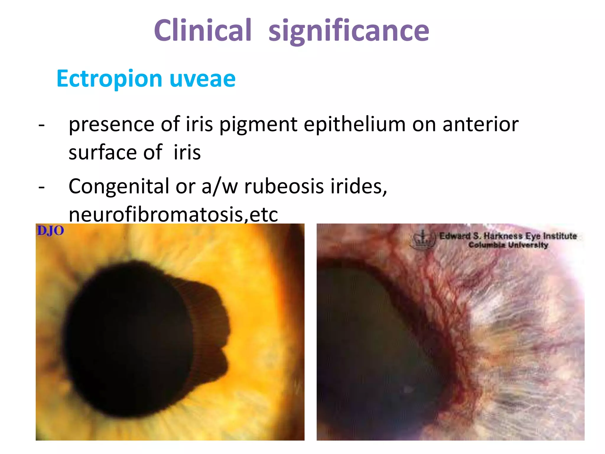 Uvea: Anatomy, Nerve & Vascular Supply, Clinical Correlation | PPTX