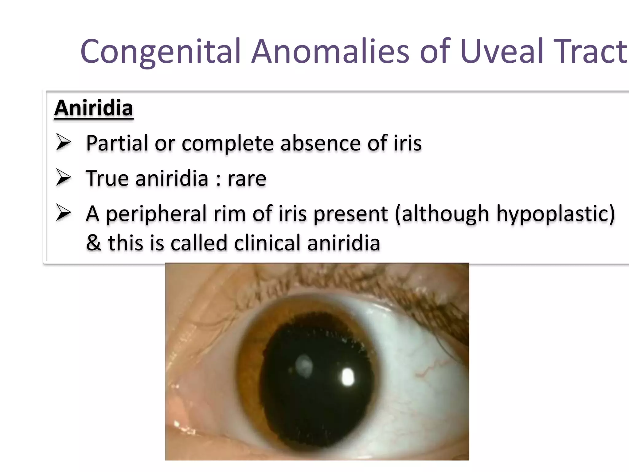 Uvea: Anatomy, Nerve & Vascular Supply, Clinical Correlation | PPTX