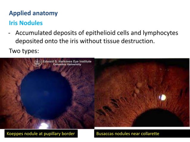 Uvea: Anatomy, Nerve & Vascular Supply, Clinical Correlation | PPTX ...