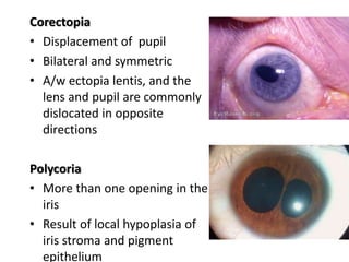 Uvea: Anatomy, Nerve & Vascular Supply, Clinical Correlation | PPT