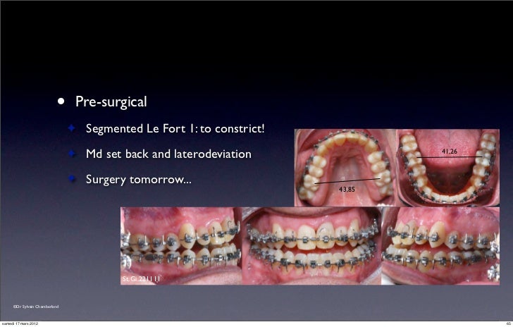 Sarpe (2 stages) vs le fort 1 (single stage) approach to complex maxi…
