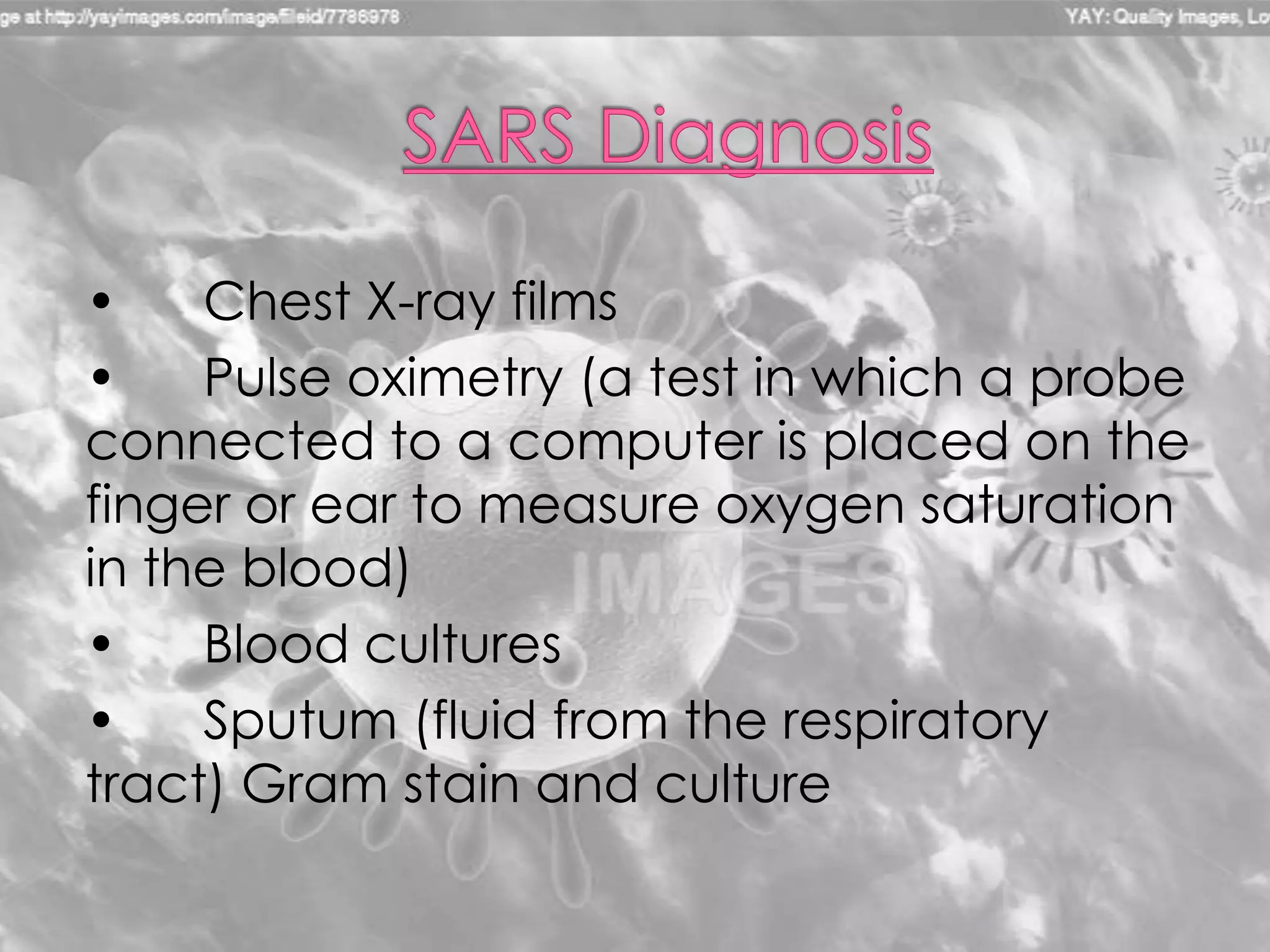 Sars | PPTX | Infectious Diseases | Diseases and Conditions