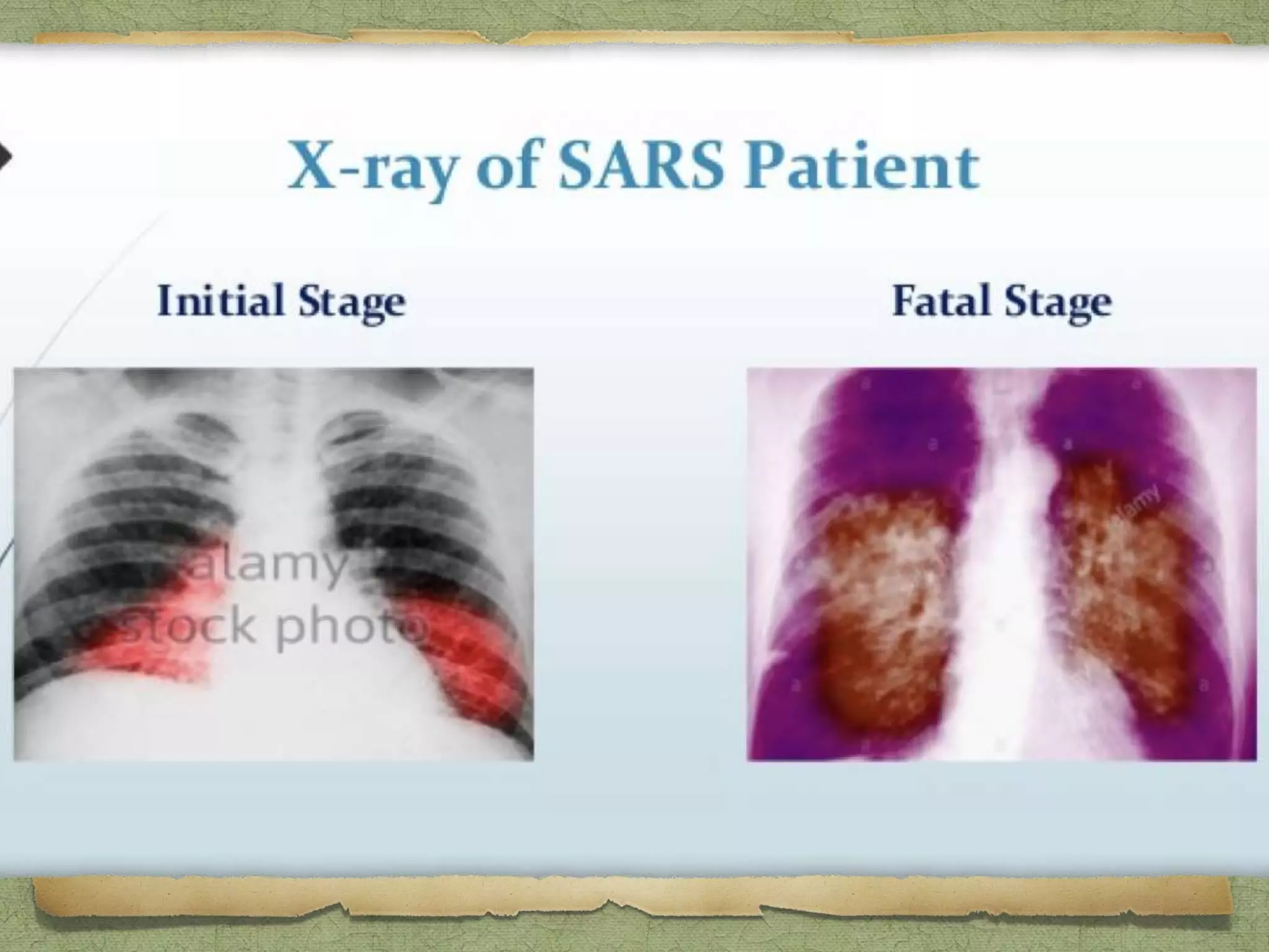 Sars ppt | PPTX