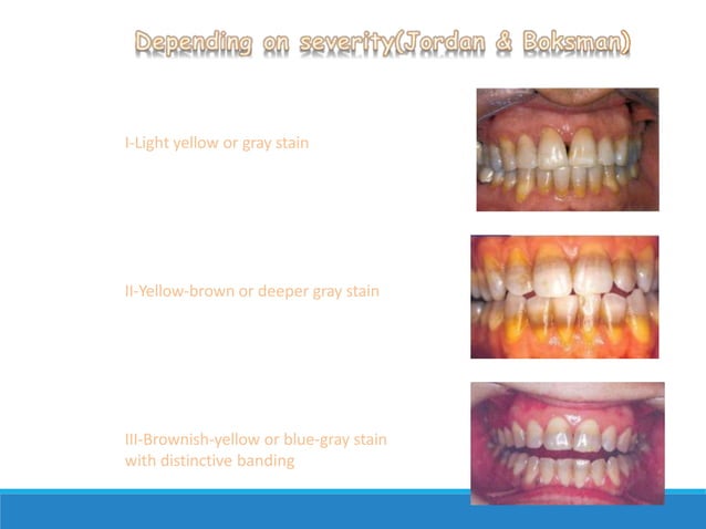 bleaching of tooth | PPTX | Dental Health | Diseases and Conditions