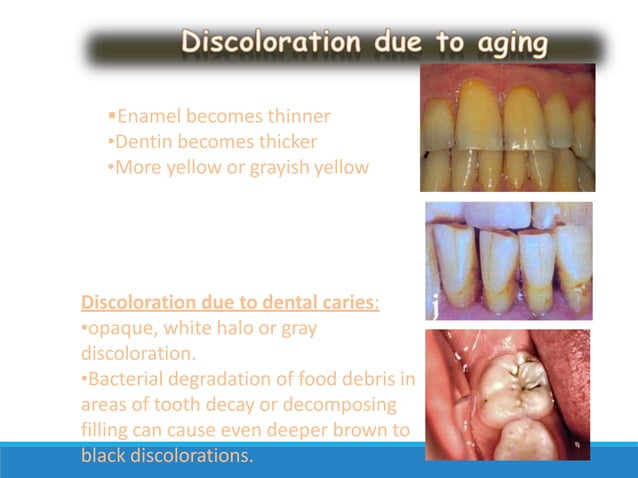 bleaching of tooth | PPTX | Dental Health | Diseases and Conditions