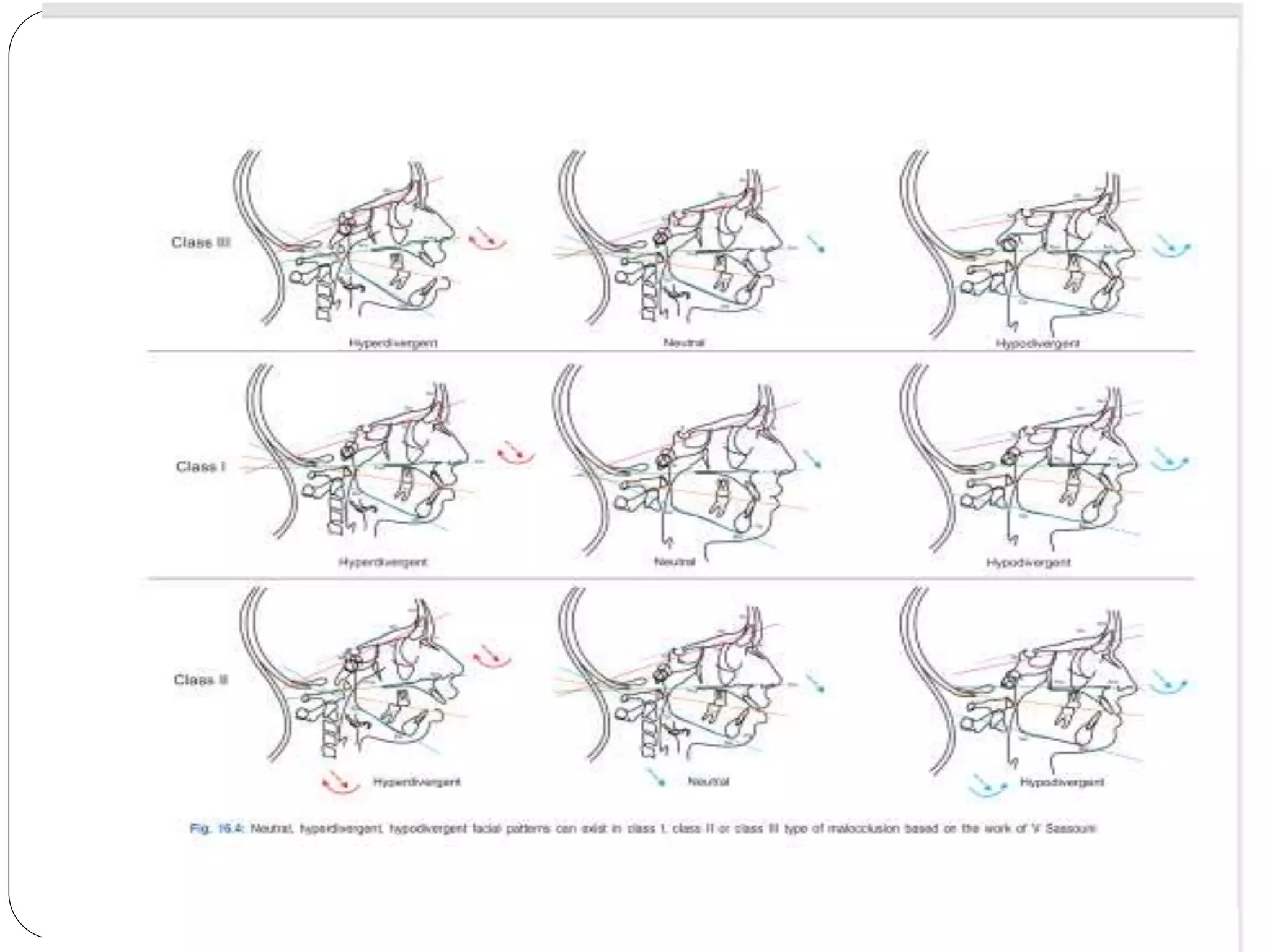 Sassouni's analysis | PPTX