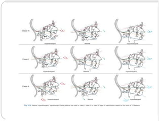 Sassouni's analysis | PPTX