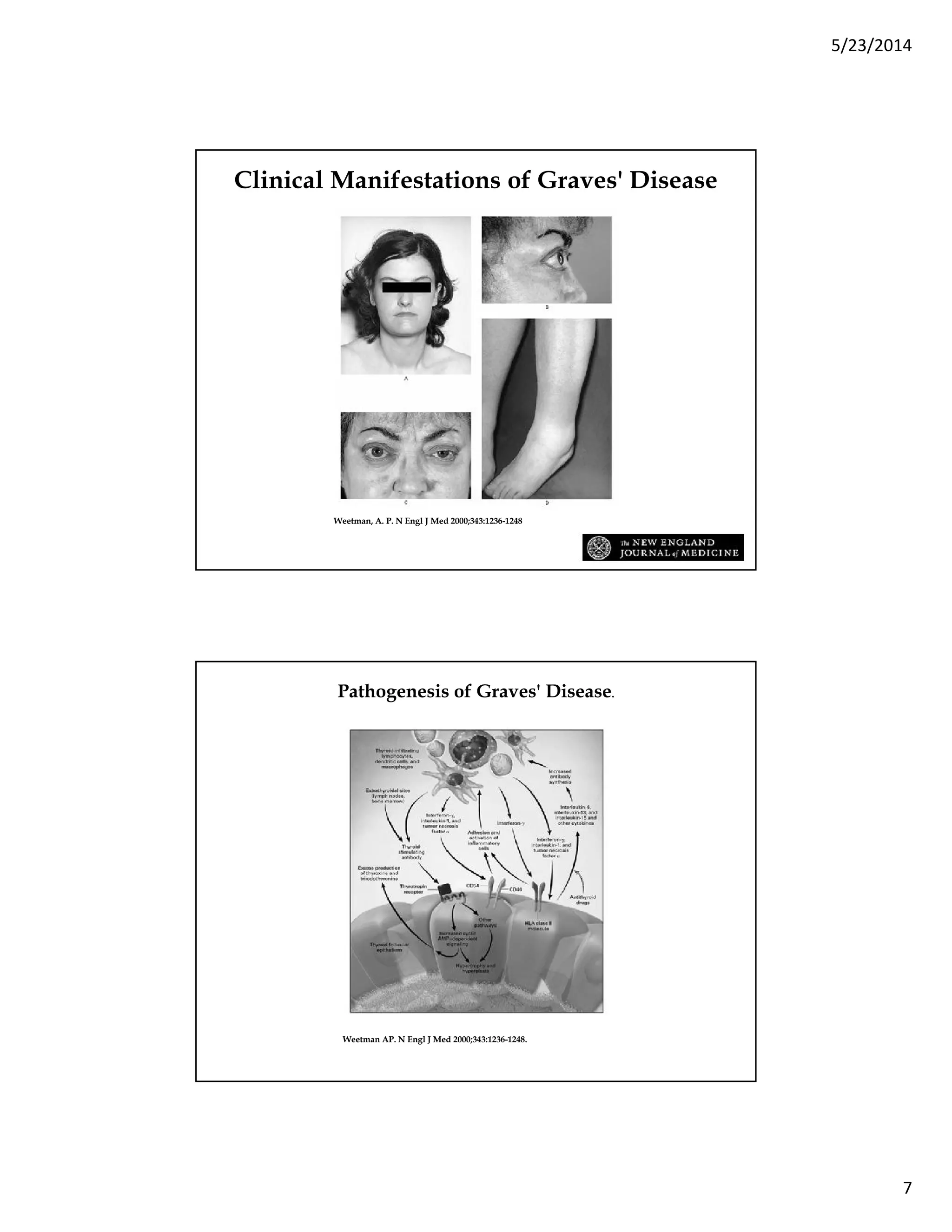 Sat 1420-thyrotoxicosis- -seasons | PDF