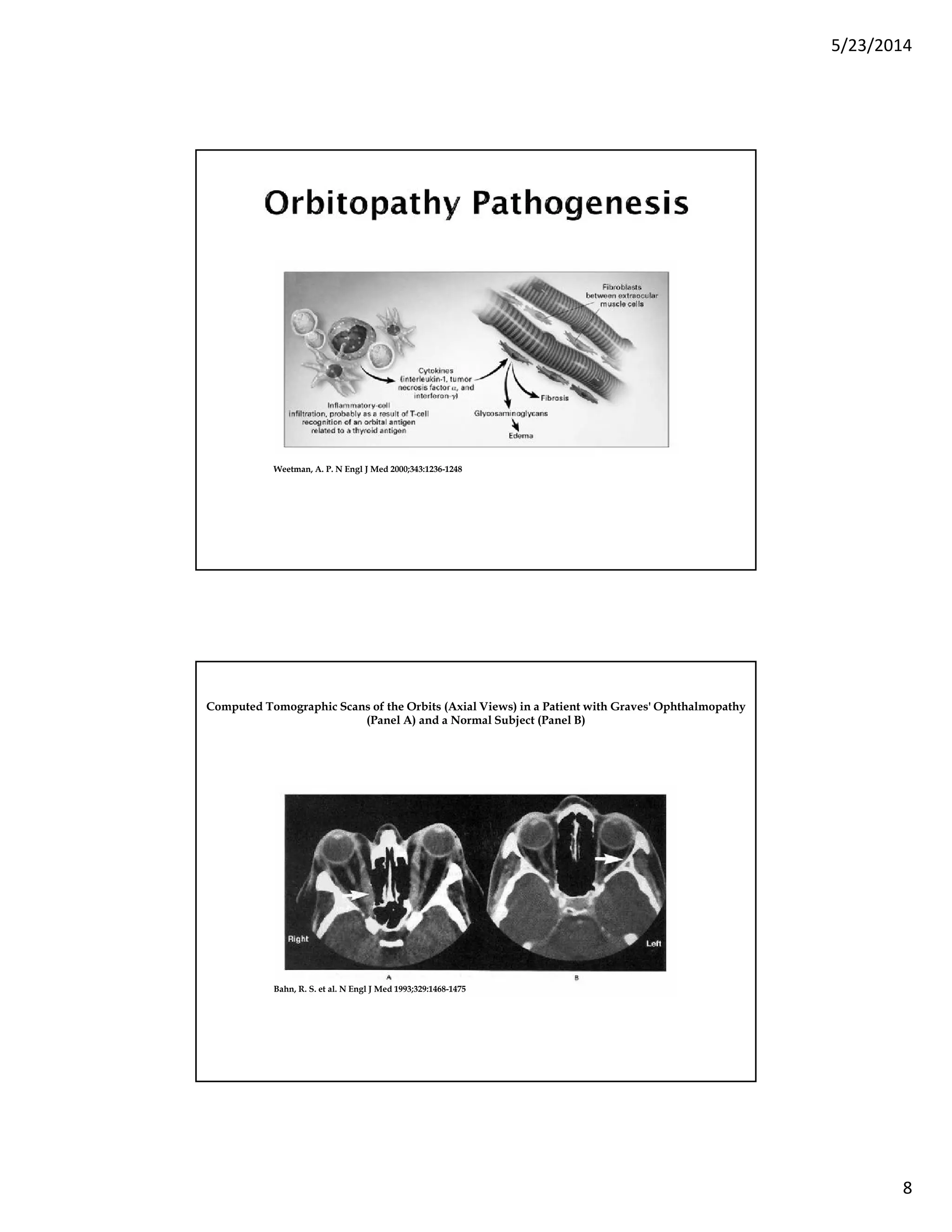 Sat 1420-thyrotoxicosis- -seasons | PDF