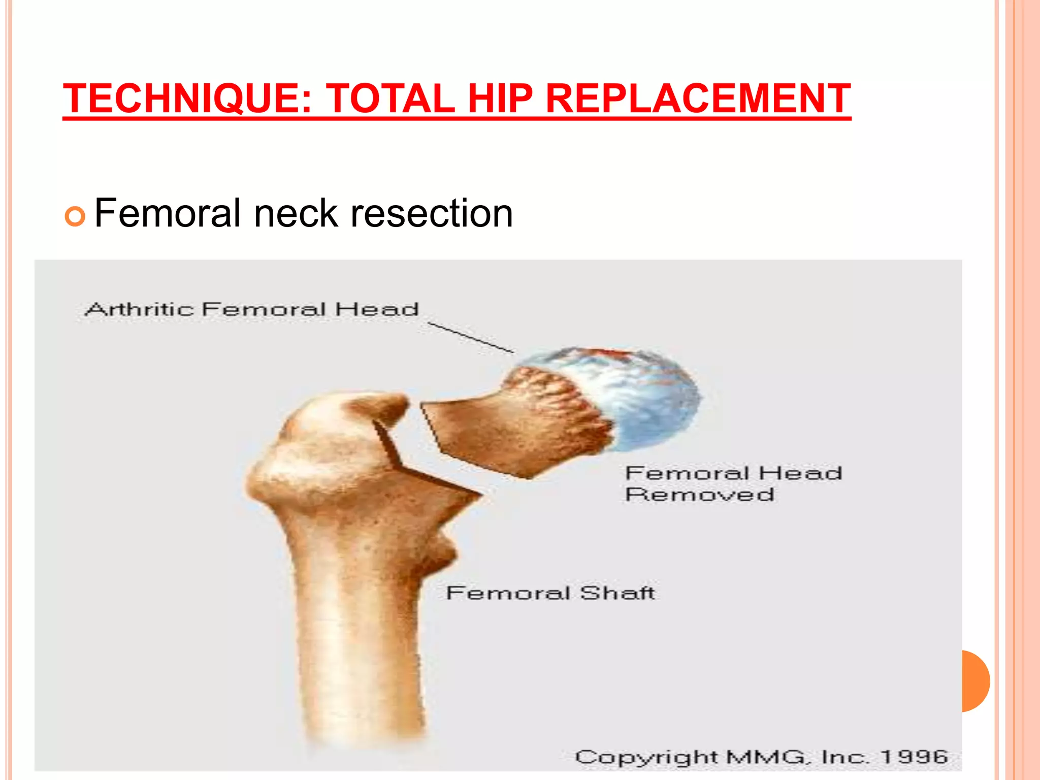 Total joint replacement surgeries | PPT