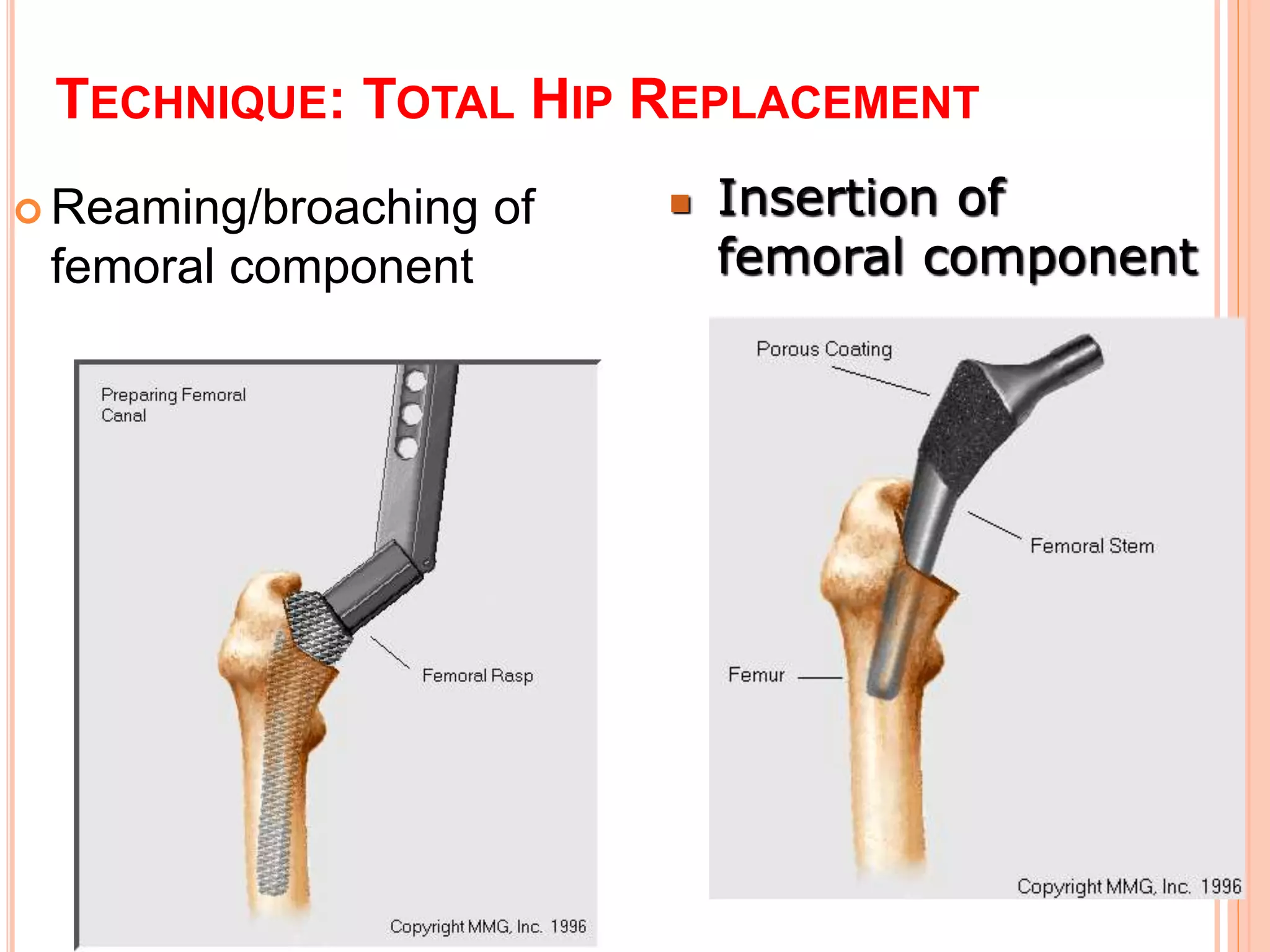 Total joint replacement surgeries | PPT
