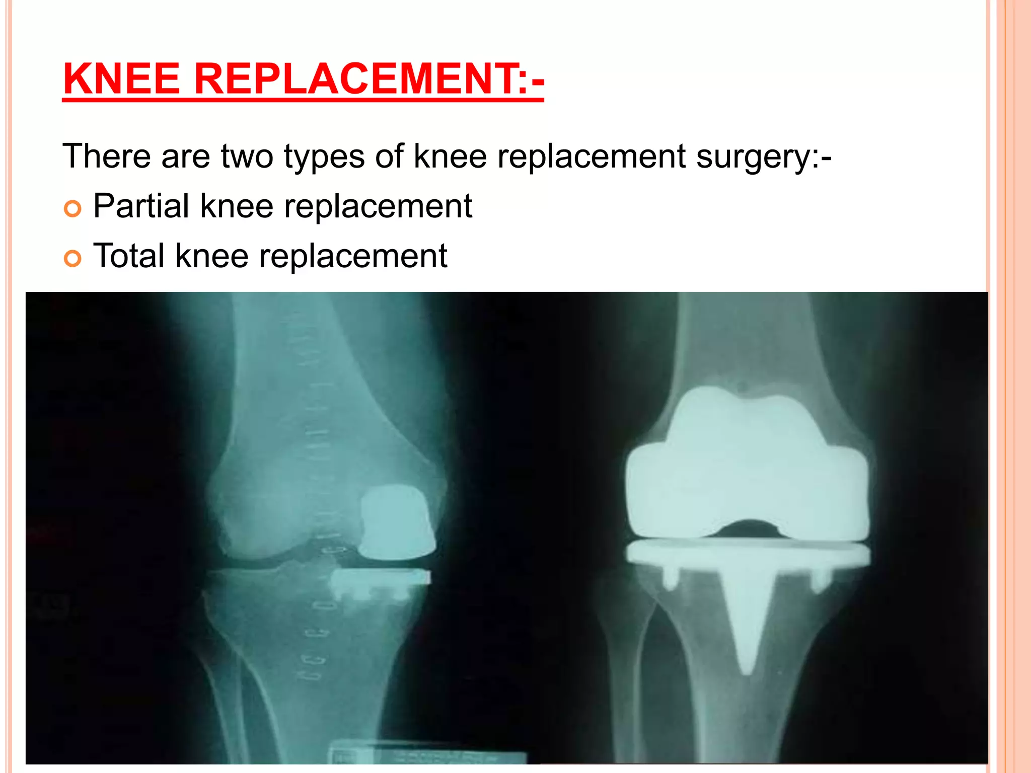 Total joint replacement surgeries | PPT