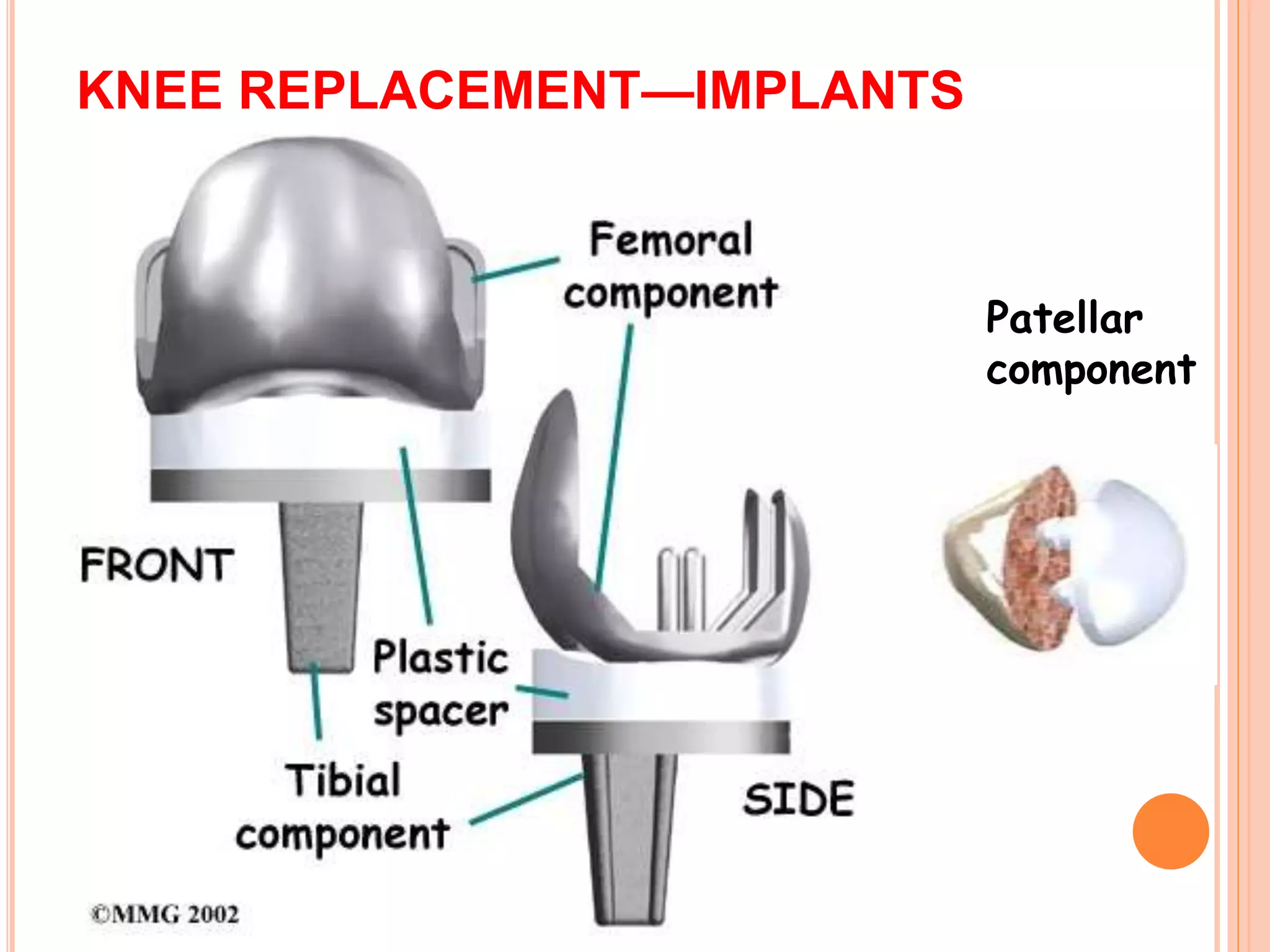 Total joint replacement surgeries | PPT