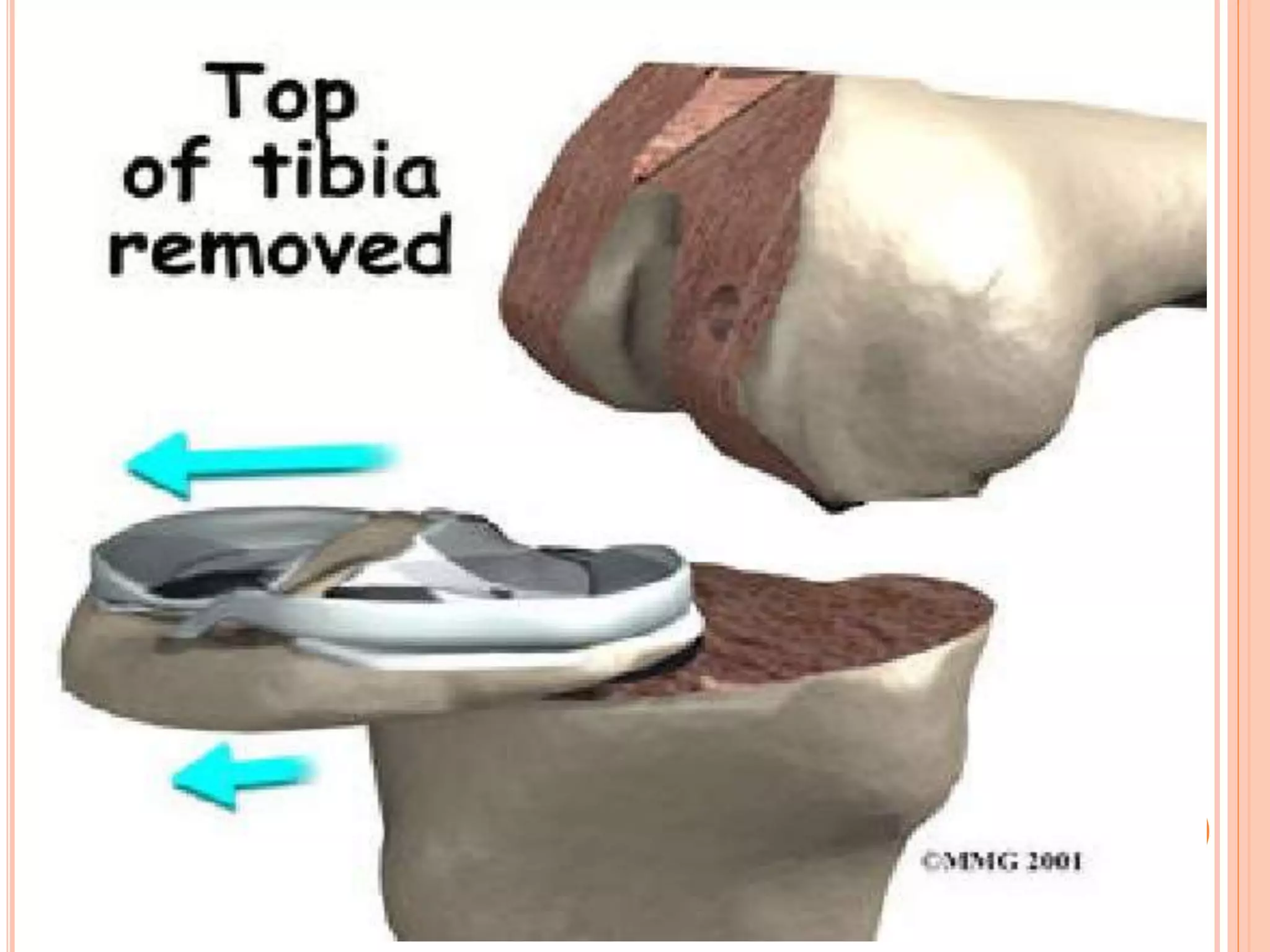 Total joint replacement surgeries | PPT