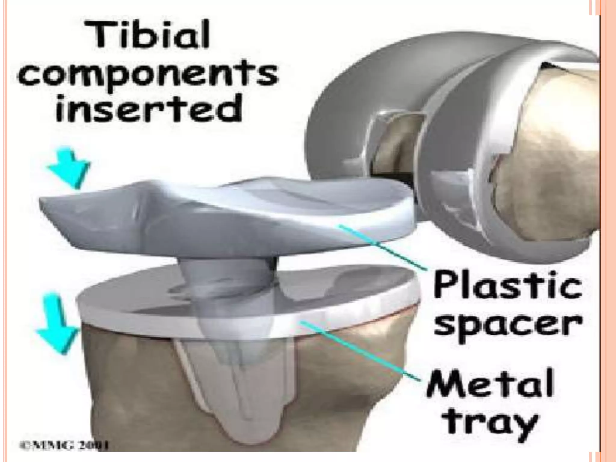 Total joint replacement surgeries | PPT