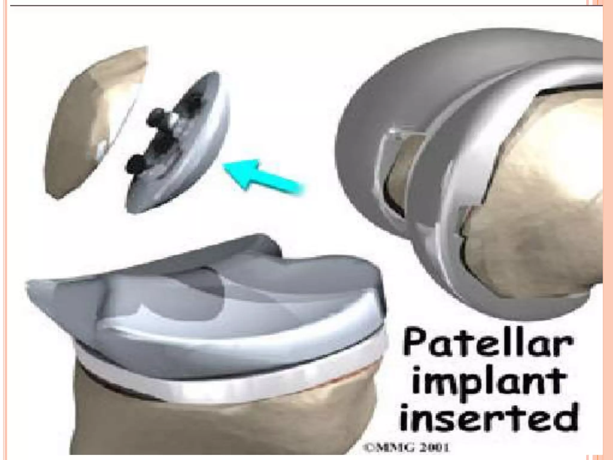 Total joint replacement surgeries | PPT
