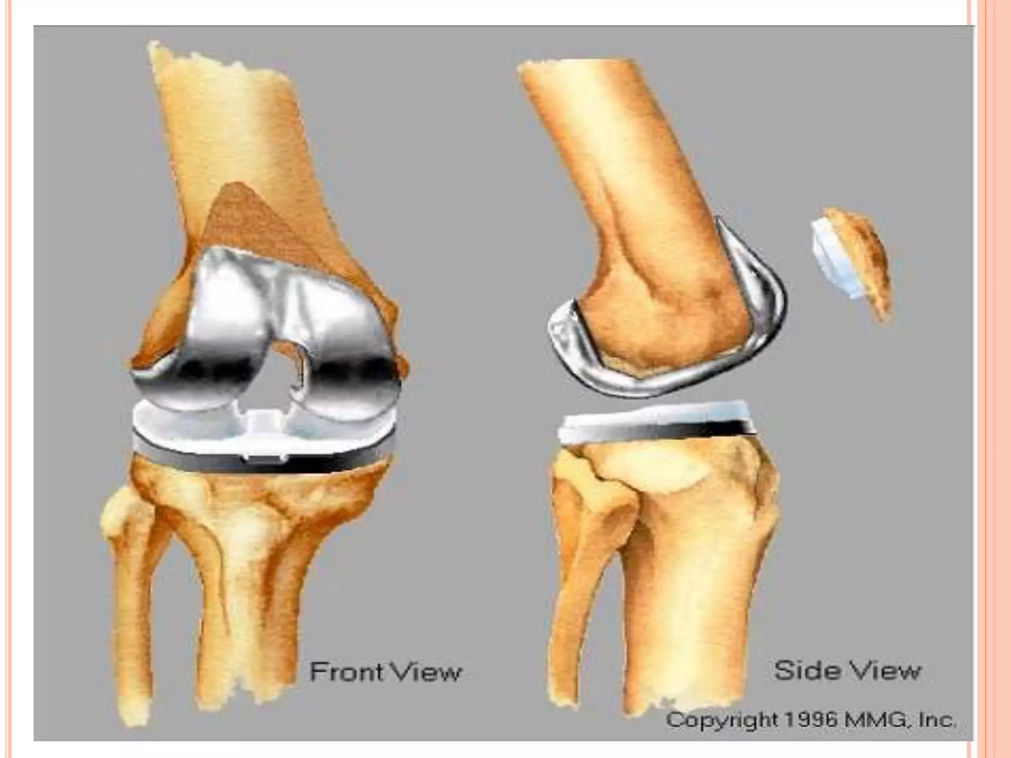 Total joint replacement surgeries | PPT