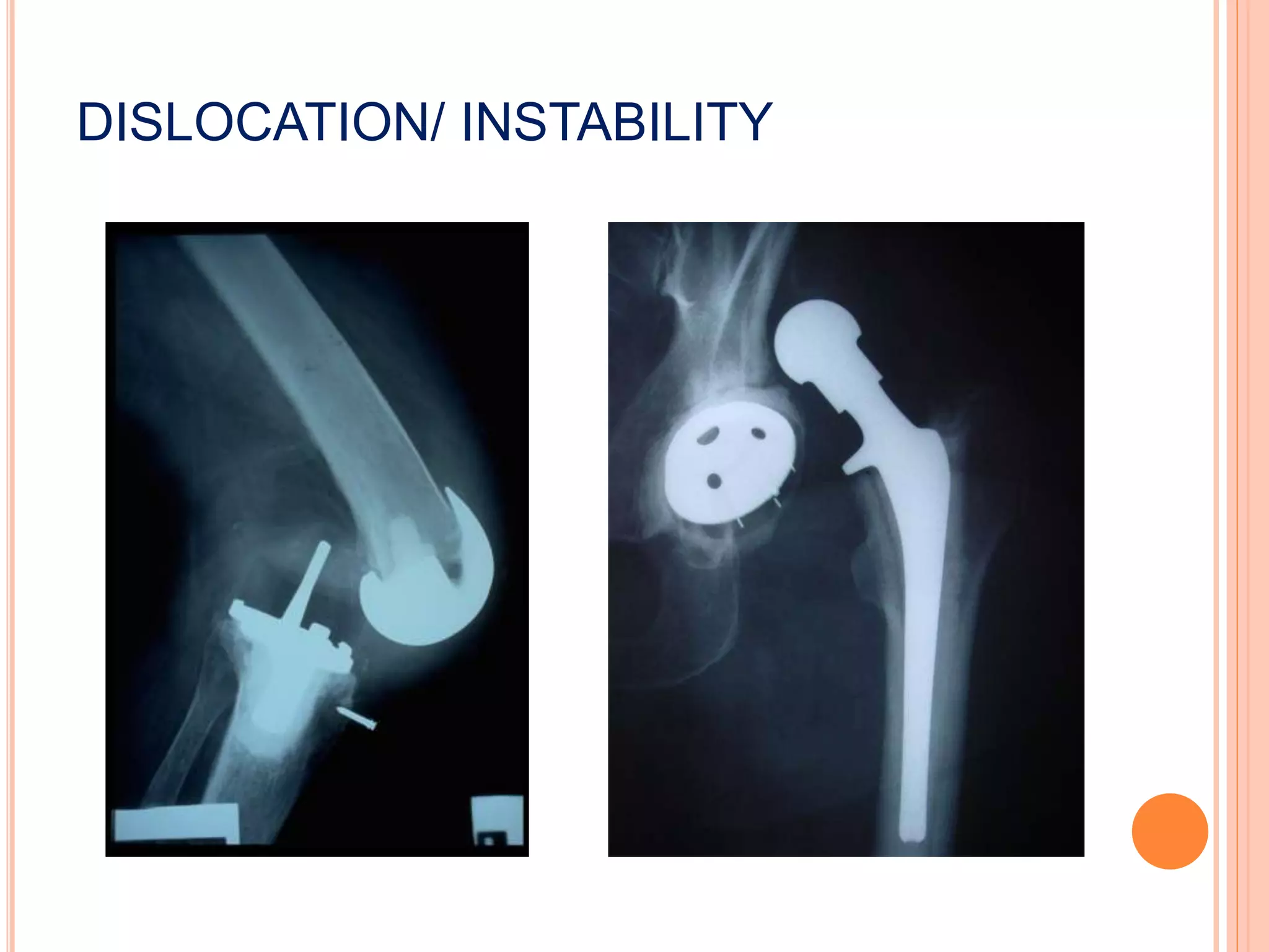 Total joint replacement surgeries | PPT