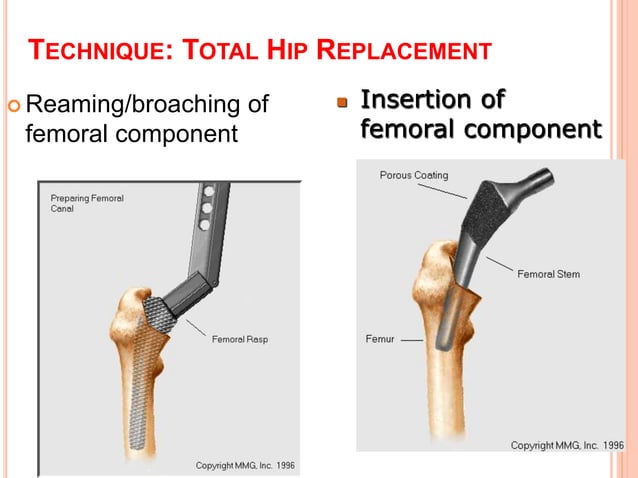 Total joint replacement surgeries | PPT | Bone and Joint Conditions ...