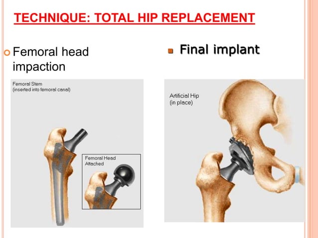 Total joint replacement surgeries | PPT | Bone and Joint Conditions ...