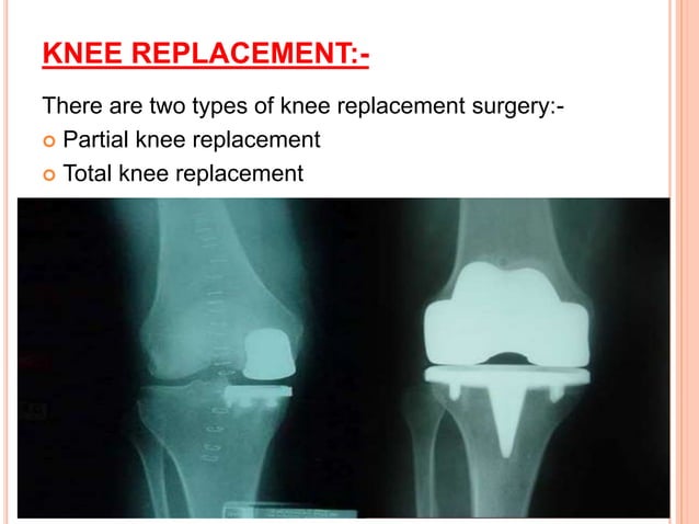 Total joint replacement surgeries | PPT | Bone and Joint Conditions ...