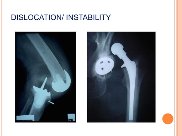 Total joint replacement surgeries | PPT | Bone and Joint Conditions ...