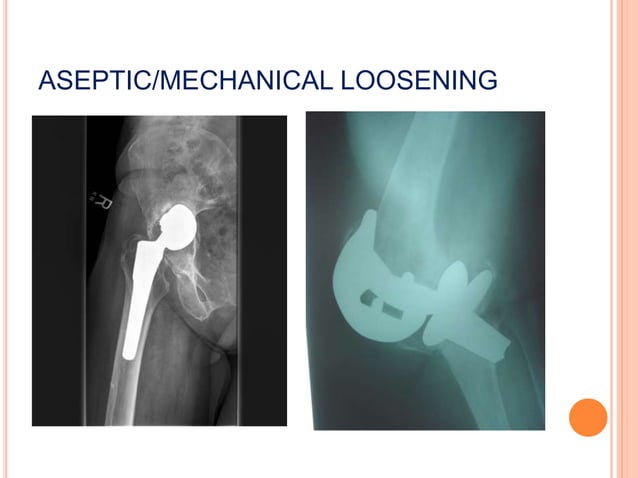 Total joint replacement surgeries | PPT | Bone and Joint Conditions ...